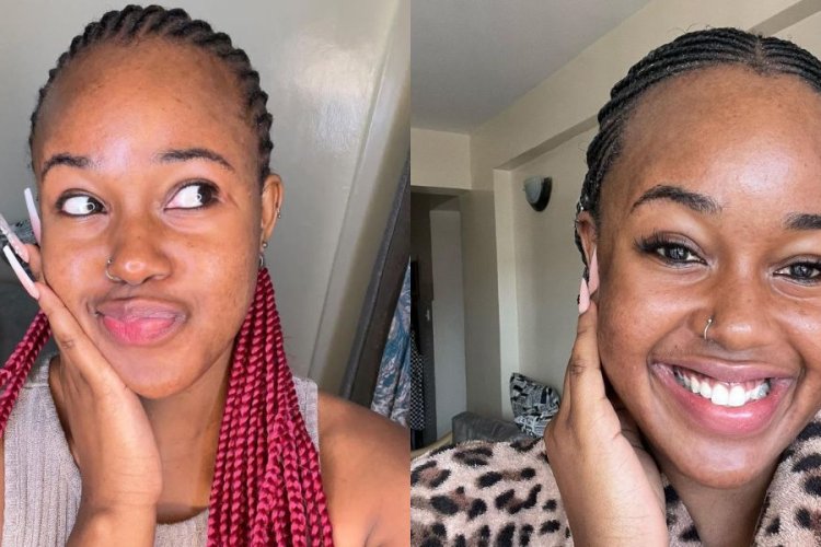 Inside Story Of Azziad Nasenya's 7-Year Battle With Acne - Viral Tea Ke